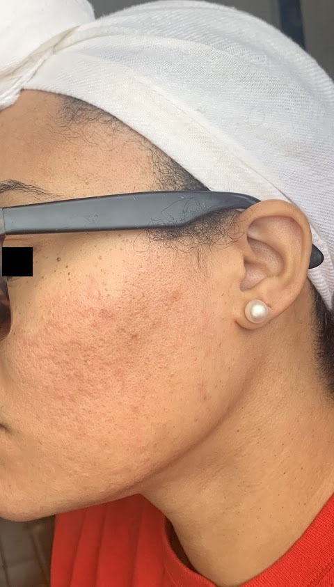 Dermarolling before and after photos from our customers